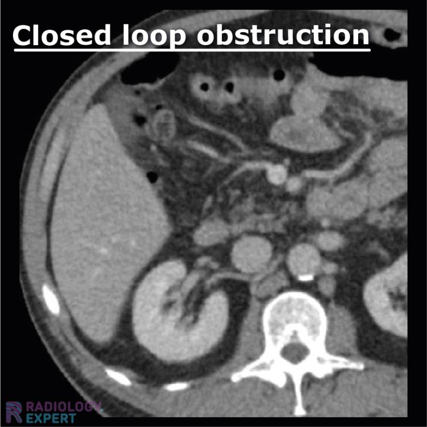 CT abdomen general